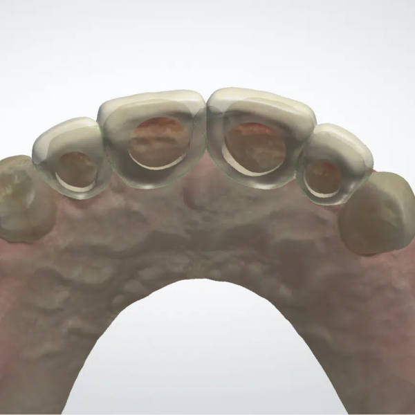 Snap on Smile - CAD Design - Viet Dental Lab - Professional Lab equipment
