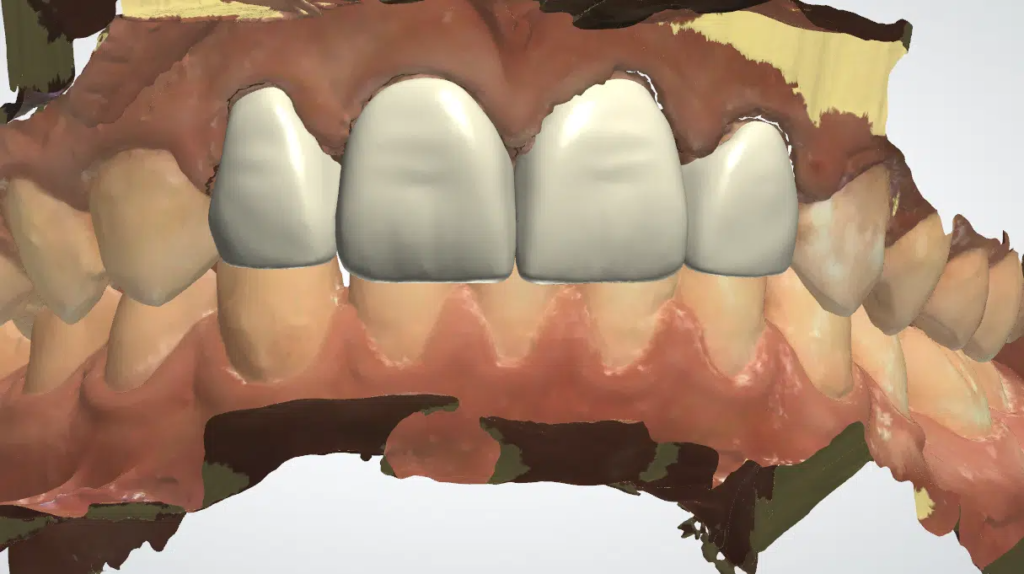 Snap-on Smile CAD Design - Natural Looking, Removable, Comfortable ...