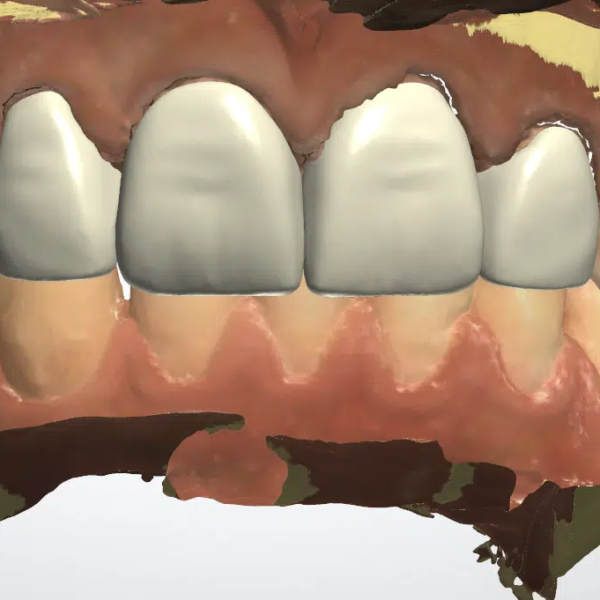 Snap on Smile - CAD Design - Viet Dental Lab - Professional Lab equipment