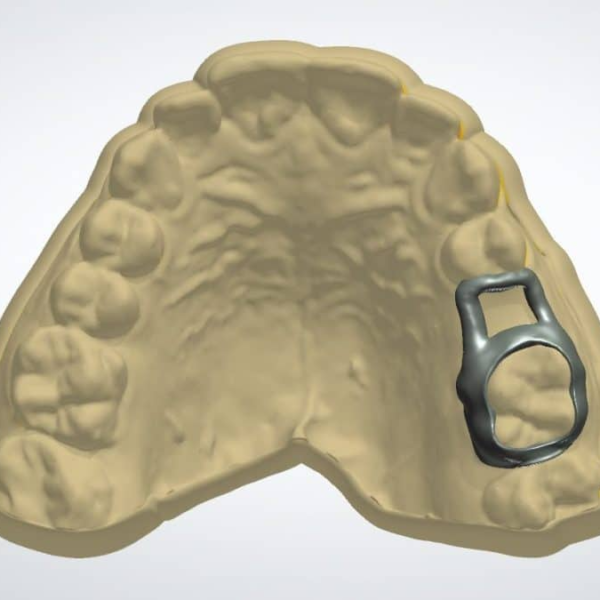 Space Maintainer - CAD Design - Viet Dental Lab - Professional Lab ...